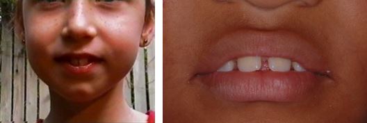Five Signs Your Child May Need Early Orthodontic Treatment